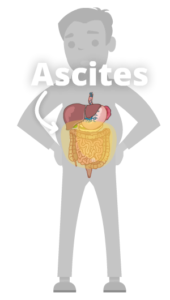 Ascites (fluid in the abdomen) - Cirrhosis Care