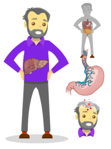 Stages of Cirrhosis – Cirrhosis Care