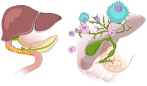 Primary Sclerosing Cholangitis (PSC) – Cirrhosis Care